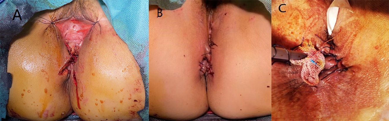 Transperineal Sphincter Repair Combined with Perineal Body ...