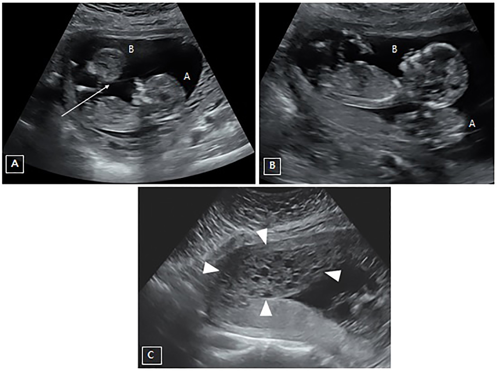 Prenatal differential diagnosis of placental mesenchymal dysplasia and ...