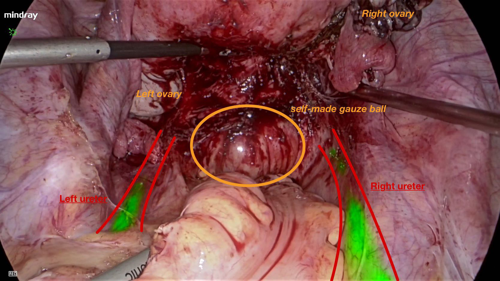 Indocyanine Green Fluorescence-Guided Laparoscopic Ureterolysis for ...