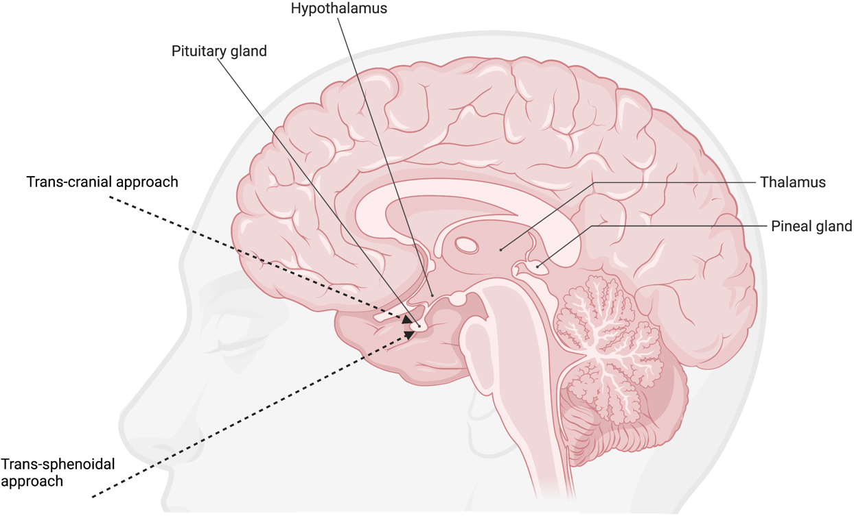 Current Approaches to Craniopharyngioma Management