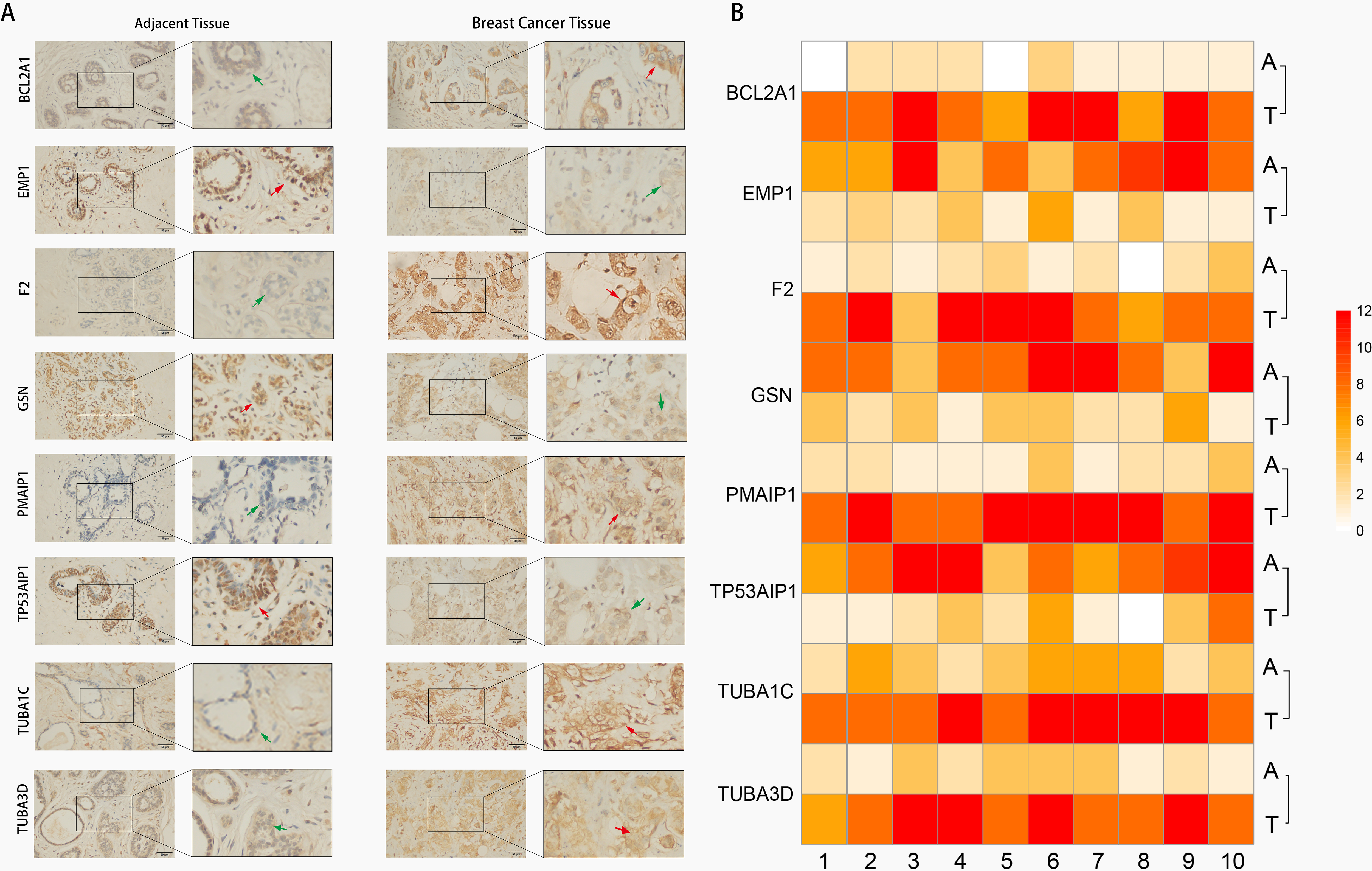 An Apoptosis-Related Specific Risk Model for Breast Cancer: From ...