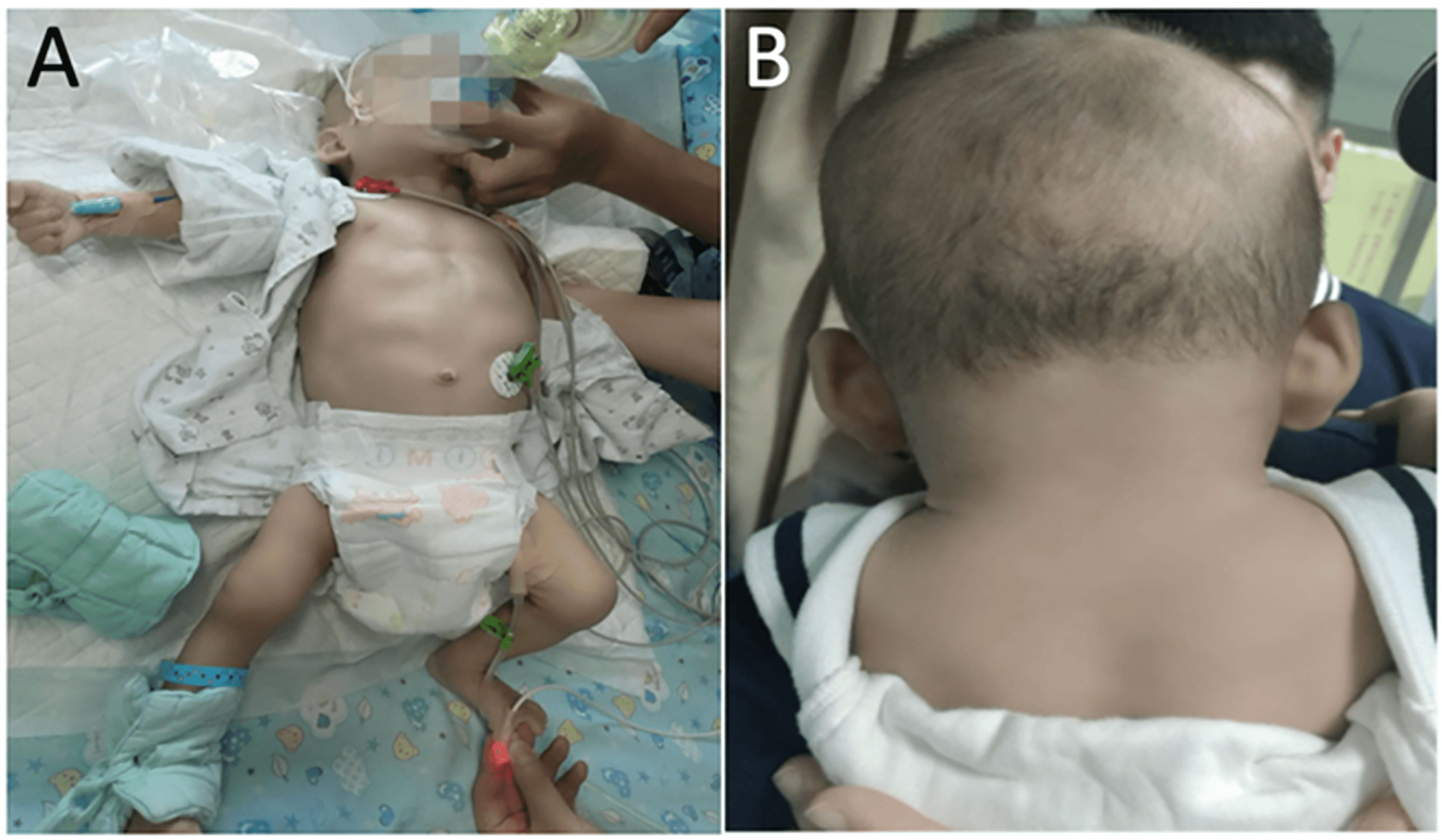 c.3G>A mutation in the CRYAB gene that causes fatal infantile ...