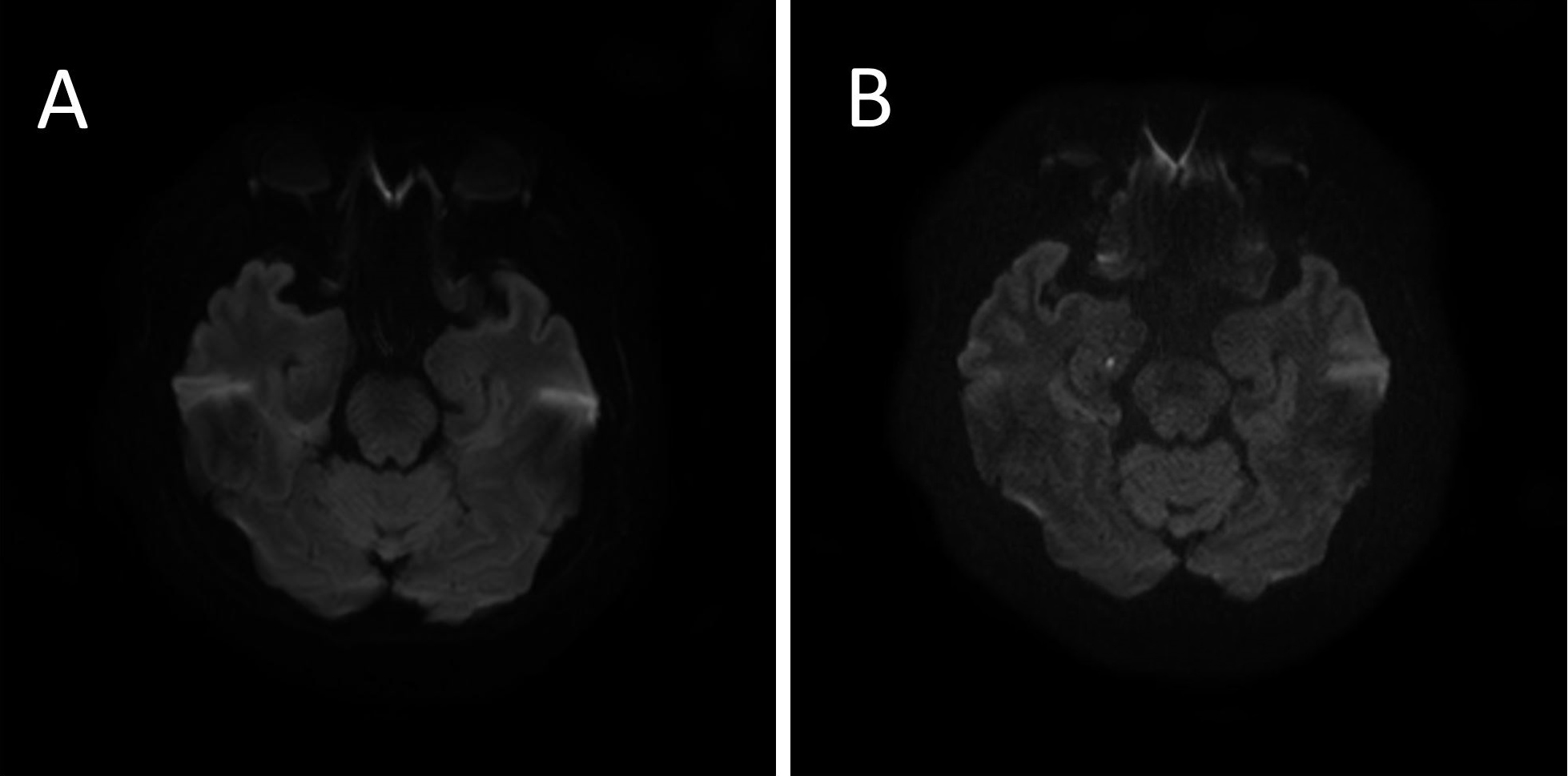 Clinical manifestation and imaging characteristics of transient global ...