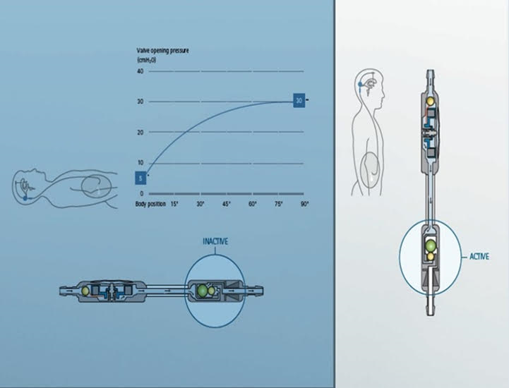 Shunt Over-drainage, Slit Ventricle Syndrome, Programmable Valves and ...