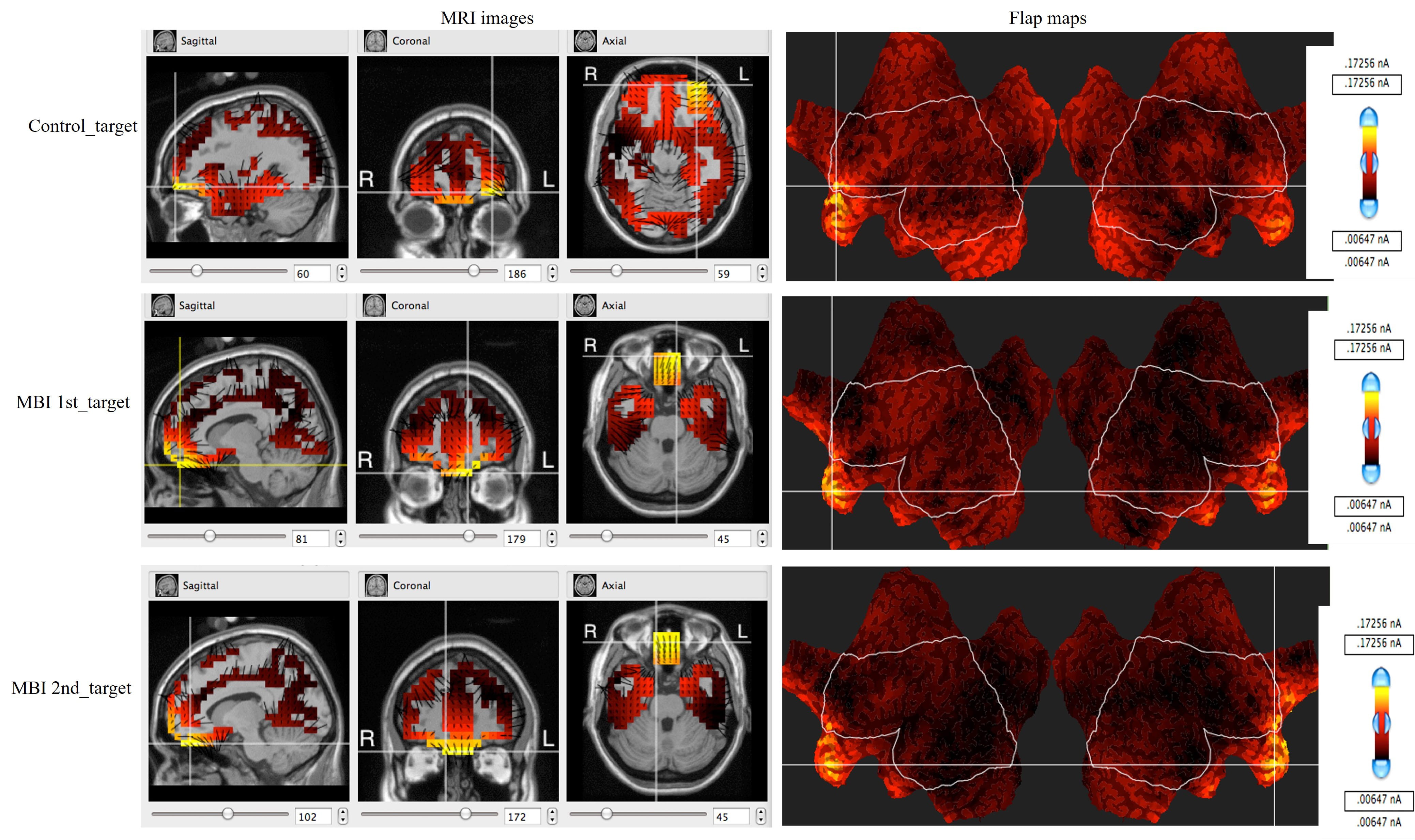 Auditory Cognitive Impairment Reflects Source Localization of the P300 ...