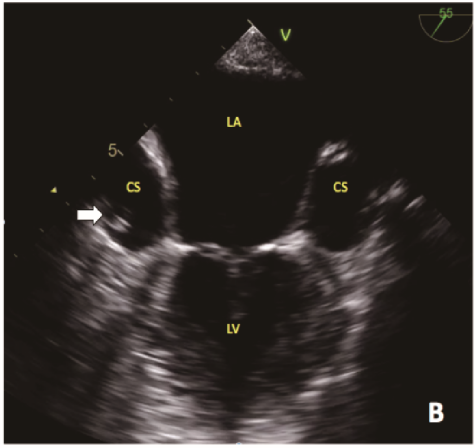Persistent left superior vena cava identified by transesophageal ...