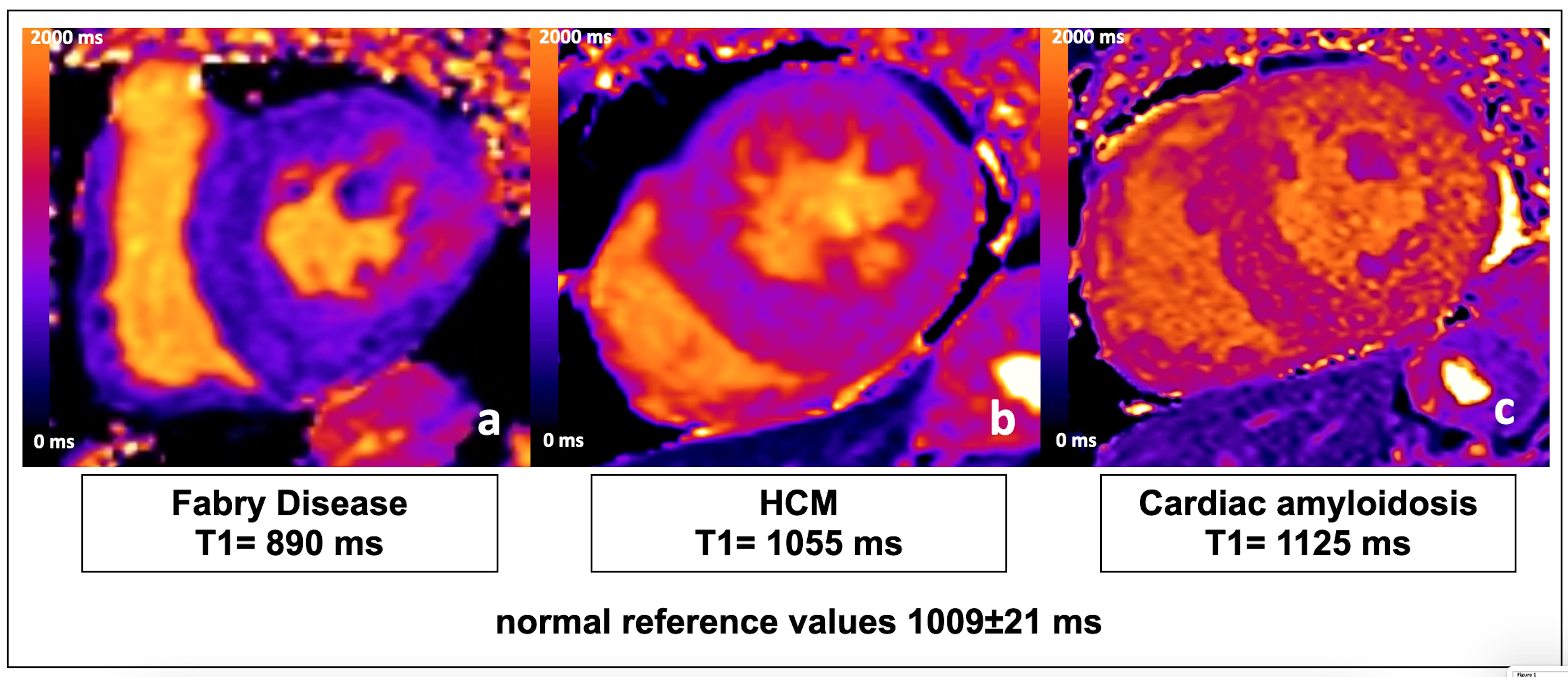 Cardiac Magnetic Resonance Features of Fabry Disease: From Early ...