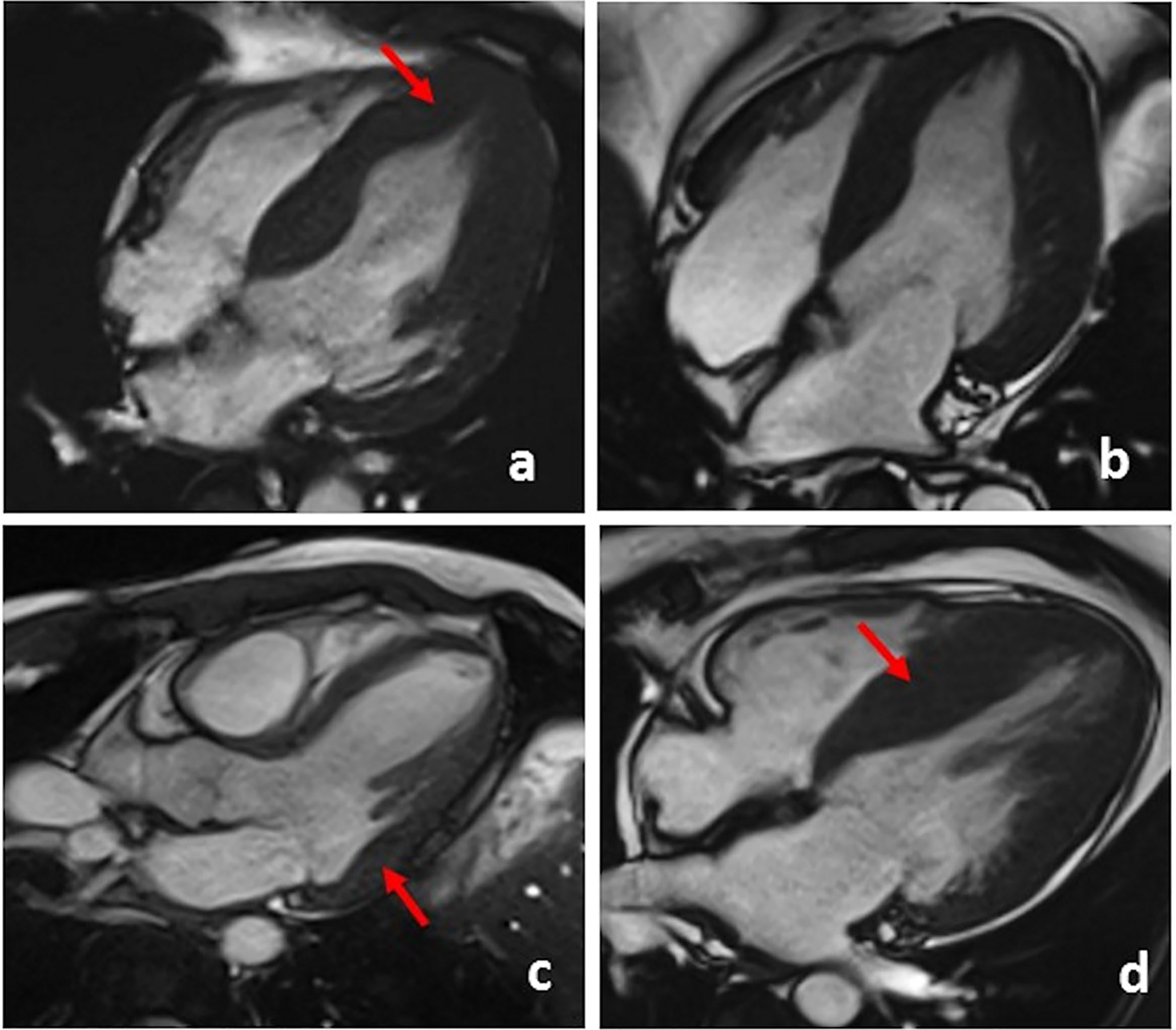 Cardiac Magnetic Resonance Features of Fabry Disease: From Early ...