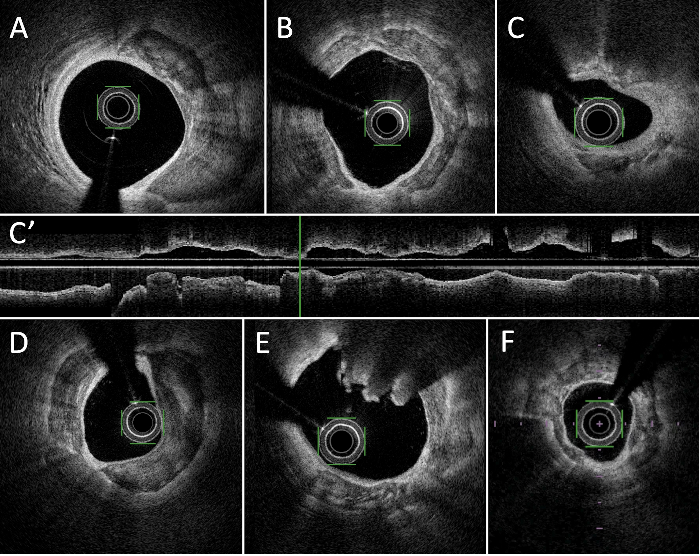 Contribution of the Optical Coherence Tomography in Calcified Lesions