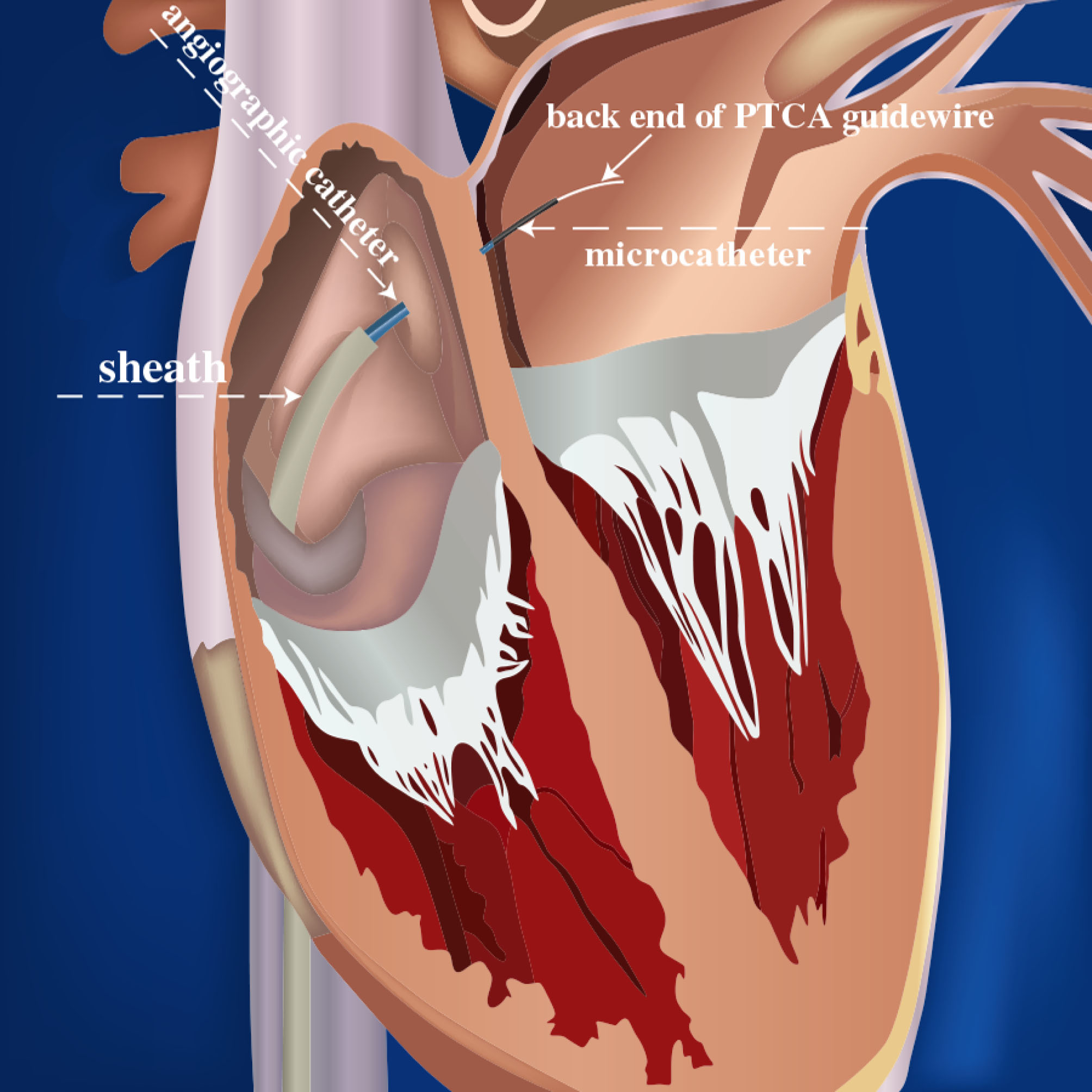 Needle-free, Novel Fossa Ovalis Puncture with Percutaneous Transluminal ...