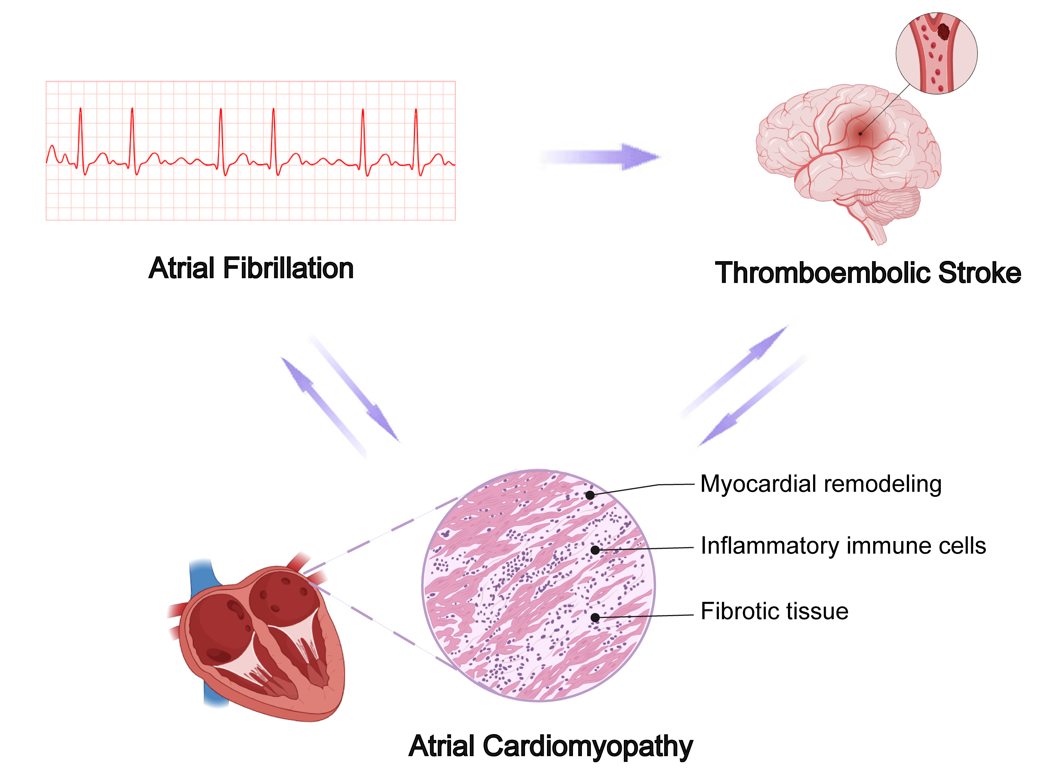 Immune Regulation in Atrial Cardiomyopathy