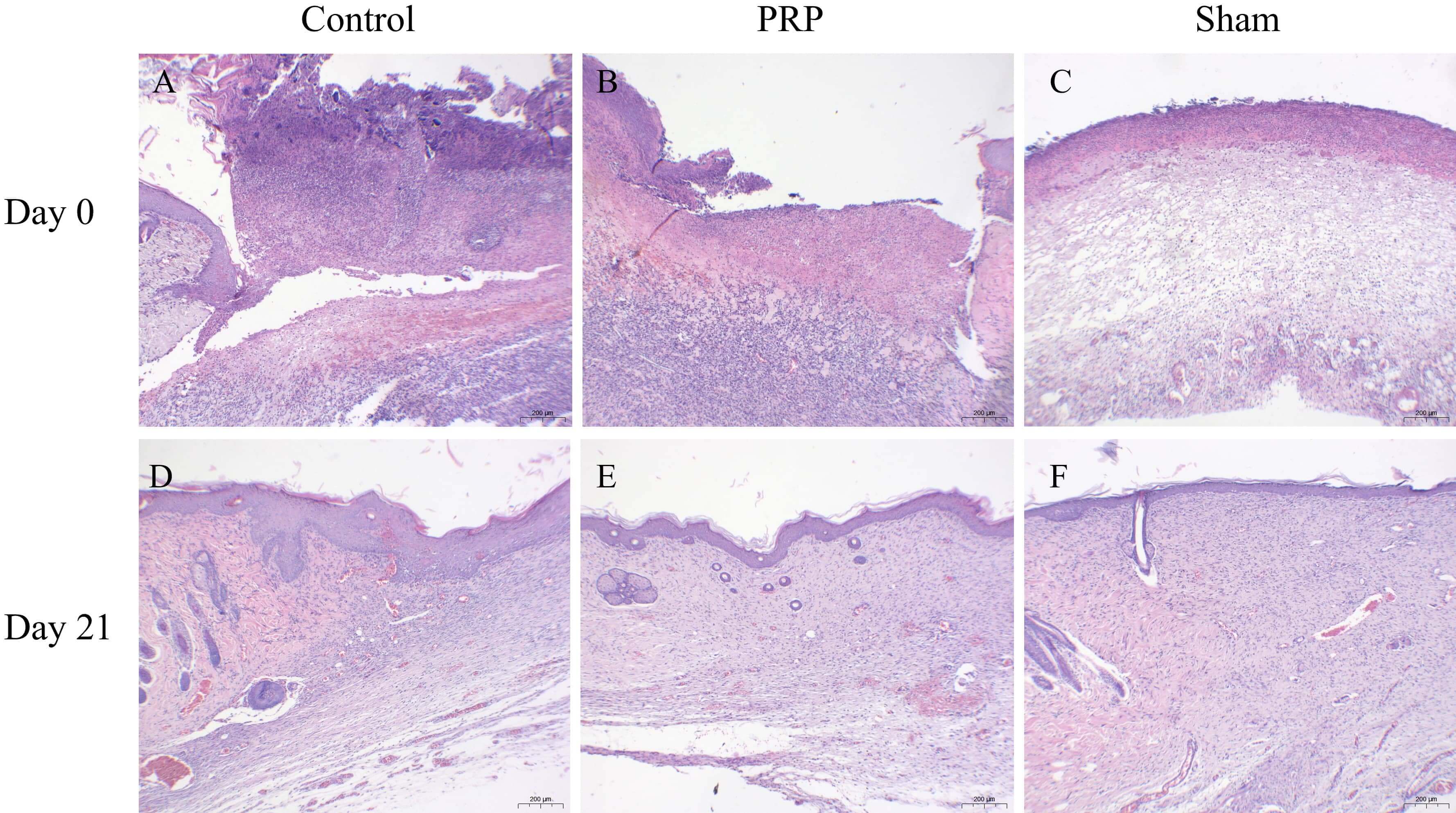 Single-Cell Dissection of Fibroblast Heterogeneity in Diabetic Ulcers ...