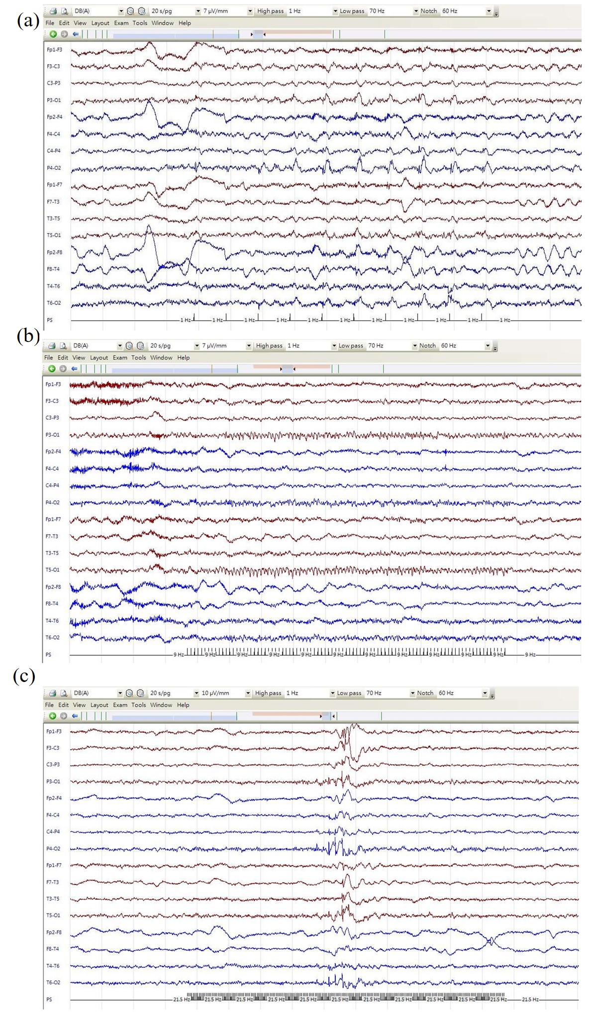 Low-Frequency Photoparoxysmal Responses in a Patient With MELAS