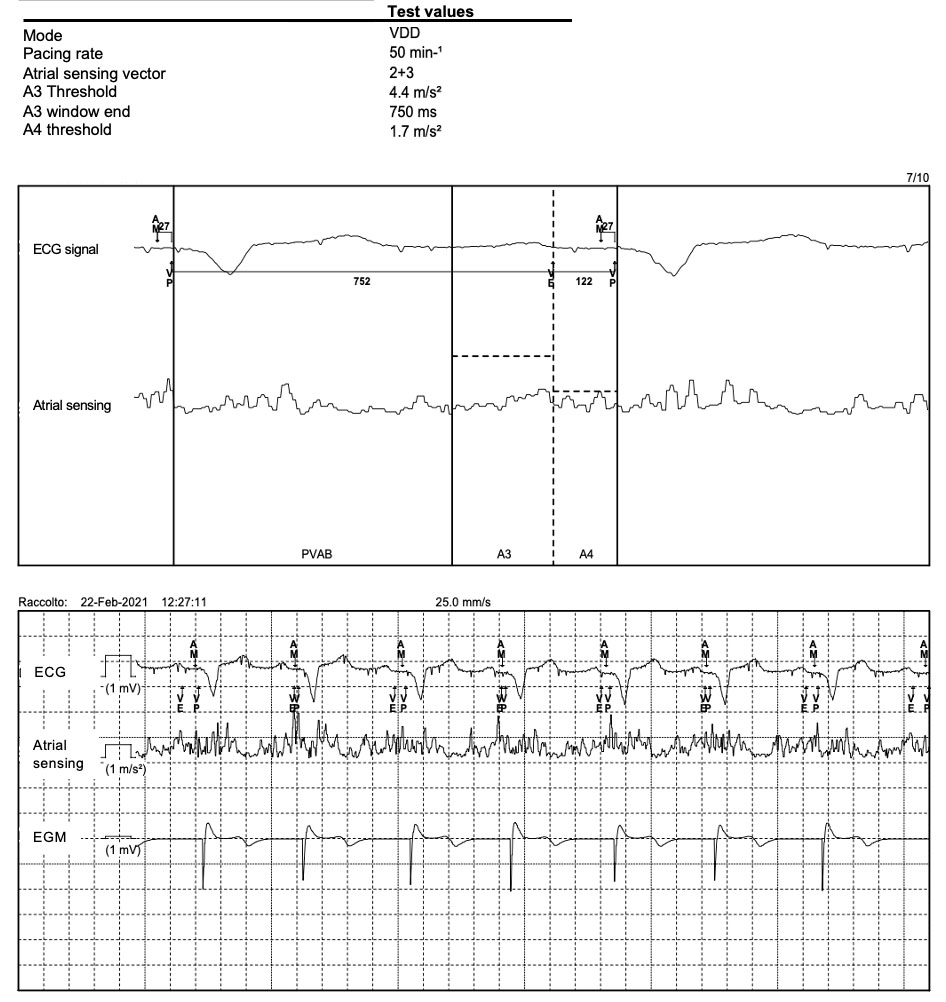 Atrioventricular synchronous leadless pacemaker: state of art and ...