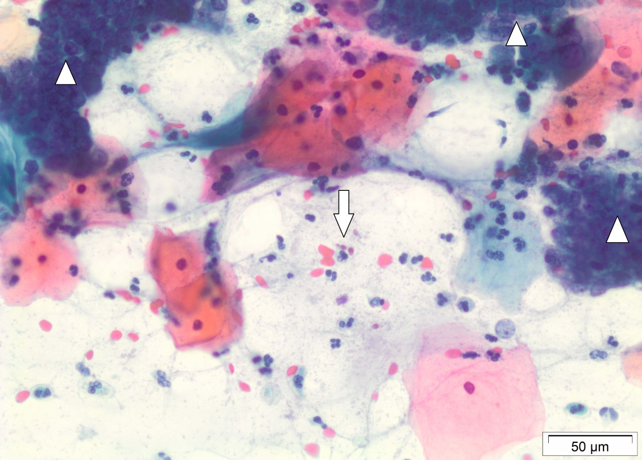 Candida albicans infection of cervix and comparison of Pap smear and ...