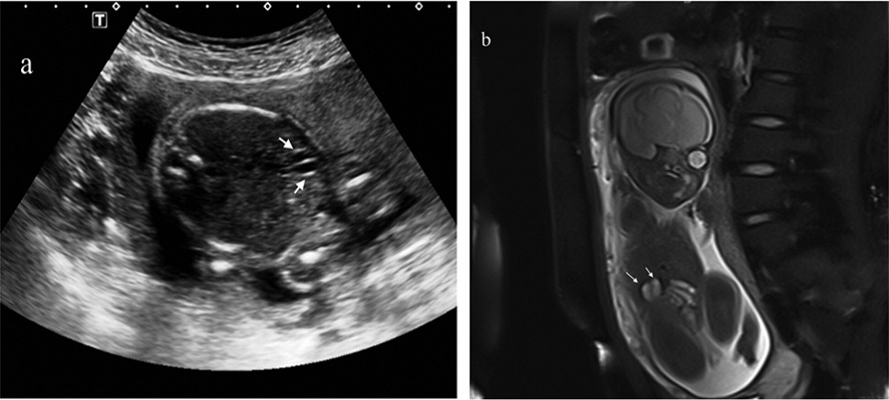 Prenatal diagnosis of fetal gallbladder duplication associated with ...