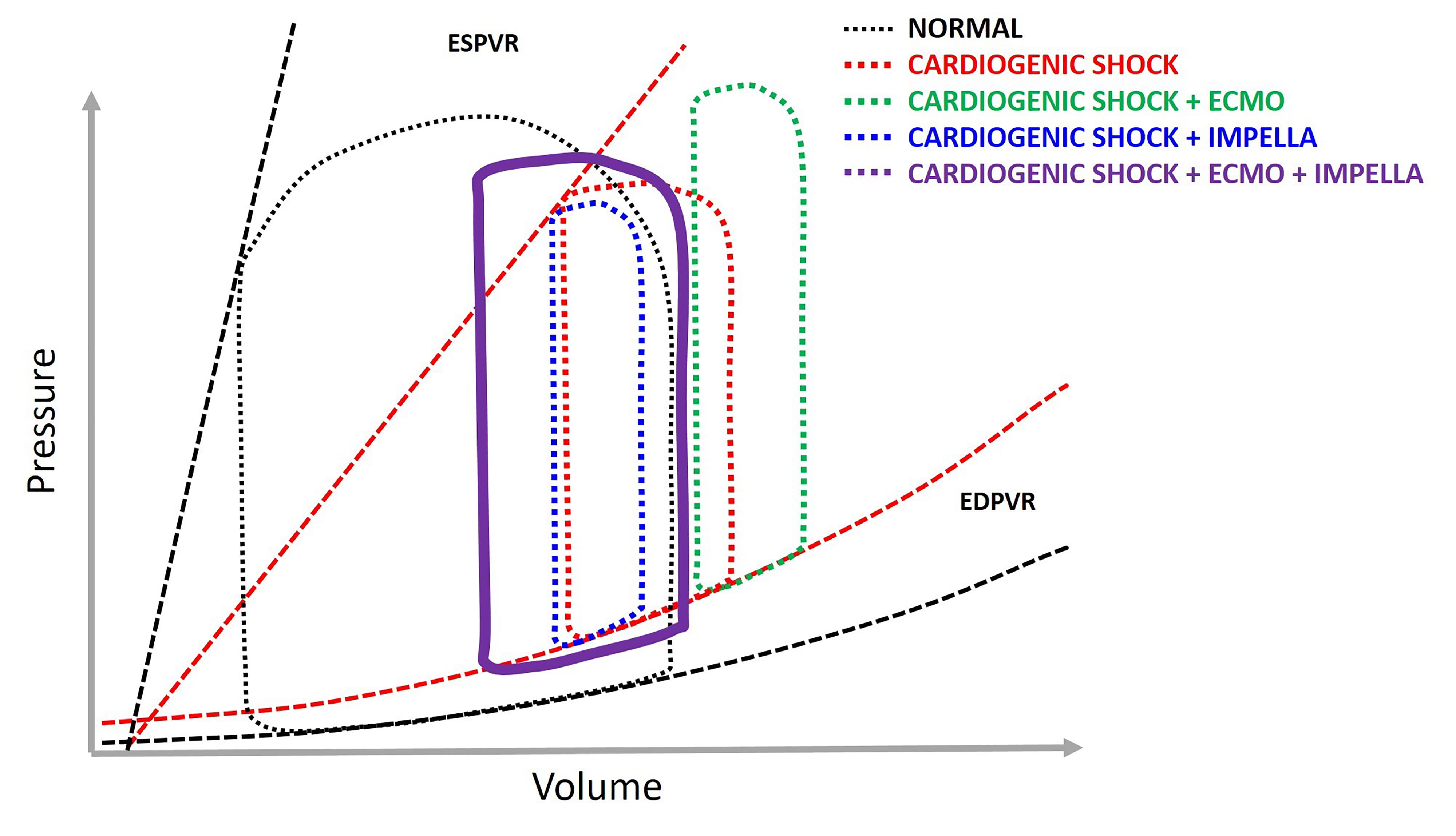 Impella combined with veno-arterial extracorporeal membrane oxygenation ...