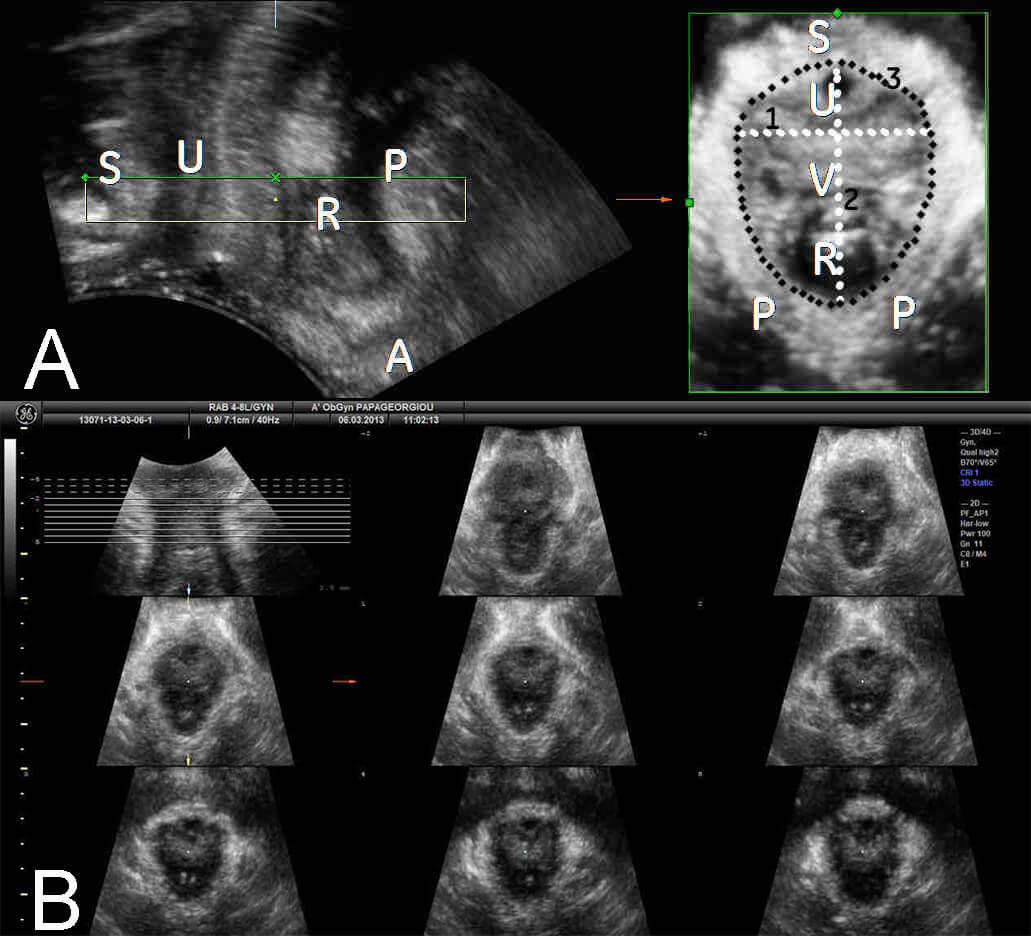 Hiatal Changes in Multiparous Women during Pregnancy and after Delivery ...